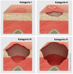 Komplikationen und Begleiterscheinungen - Neurologische ...